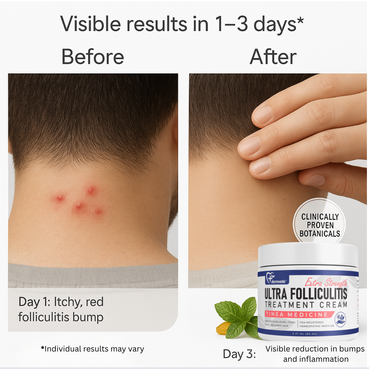 Folliculitis Treatment Cream – 3 Day Relief for Scalp, Face & Body
